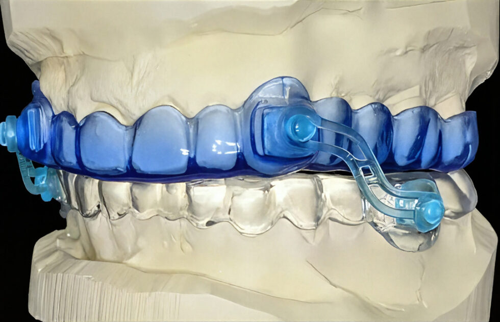 Anti-Schnarch-Schiene - kfo-krumme-lanke